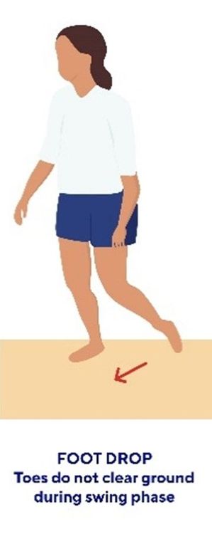 Deepening on foot drop: Abnormal Gait Cycle due to Foot drop and ...
