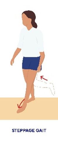 Deepening on foot drop: Abnormal Gait Cycle due to Foot drop and ...